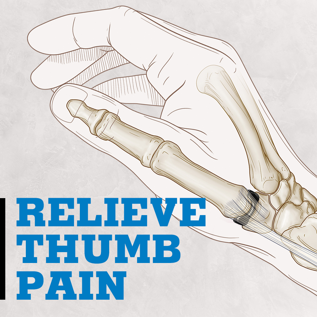 Ensemble CMC Implant: A Cutting-Edge Solution for Basal Joint Arthritis ...