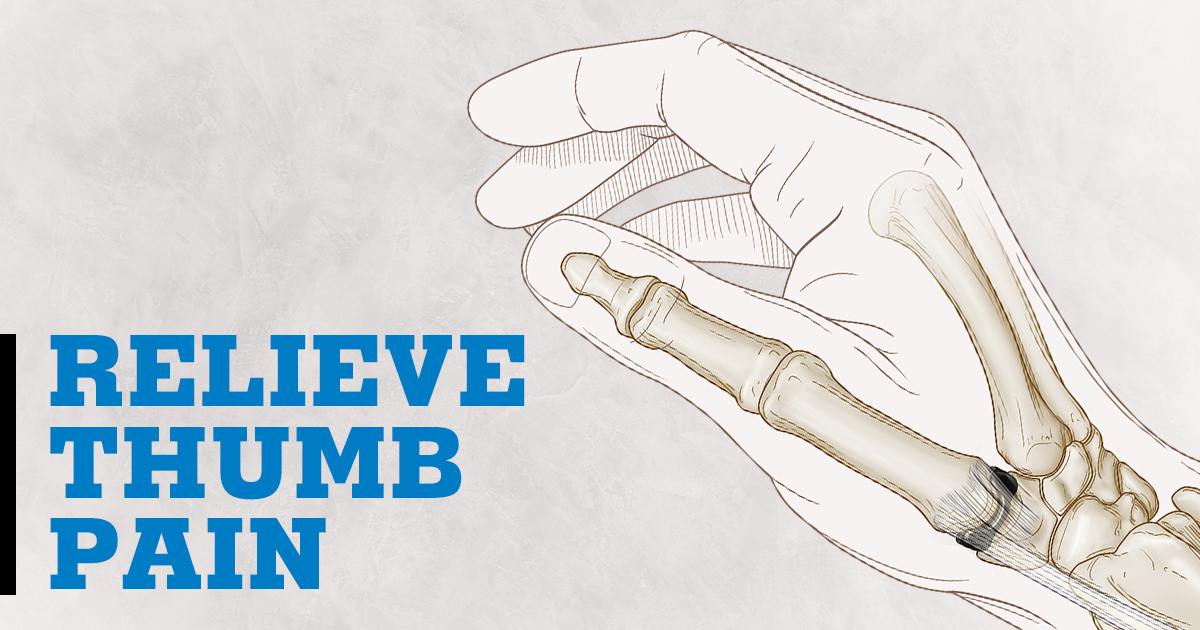 Ensemble CMC Implant: A Cutting-Edge Solution for Basal Joint Arthritis ...